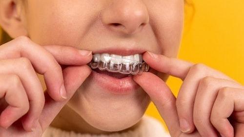 How to Clean Invisalign Clear Aligners | Invisalign and Traditional Orthodontics Aurora CO